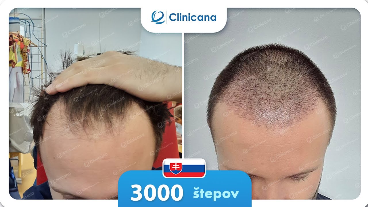 Transplantace vlasů Skutečné video recenze a posudky - Clinicana