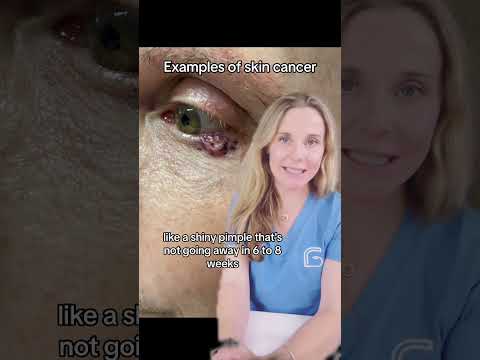 What to know about basal cell carcinoma