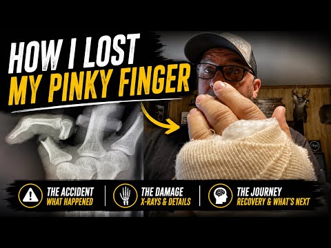 How I amputated my pinky finger. Traumatic amputation explained and ...