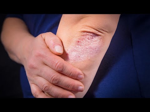 Drs. Rx: Say Goodbye to Dry Crusty Summer Skin
