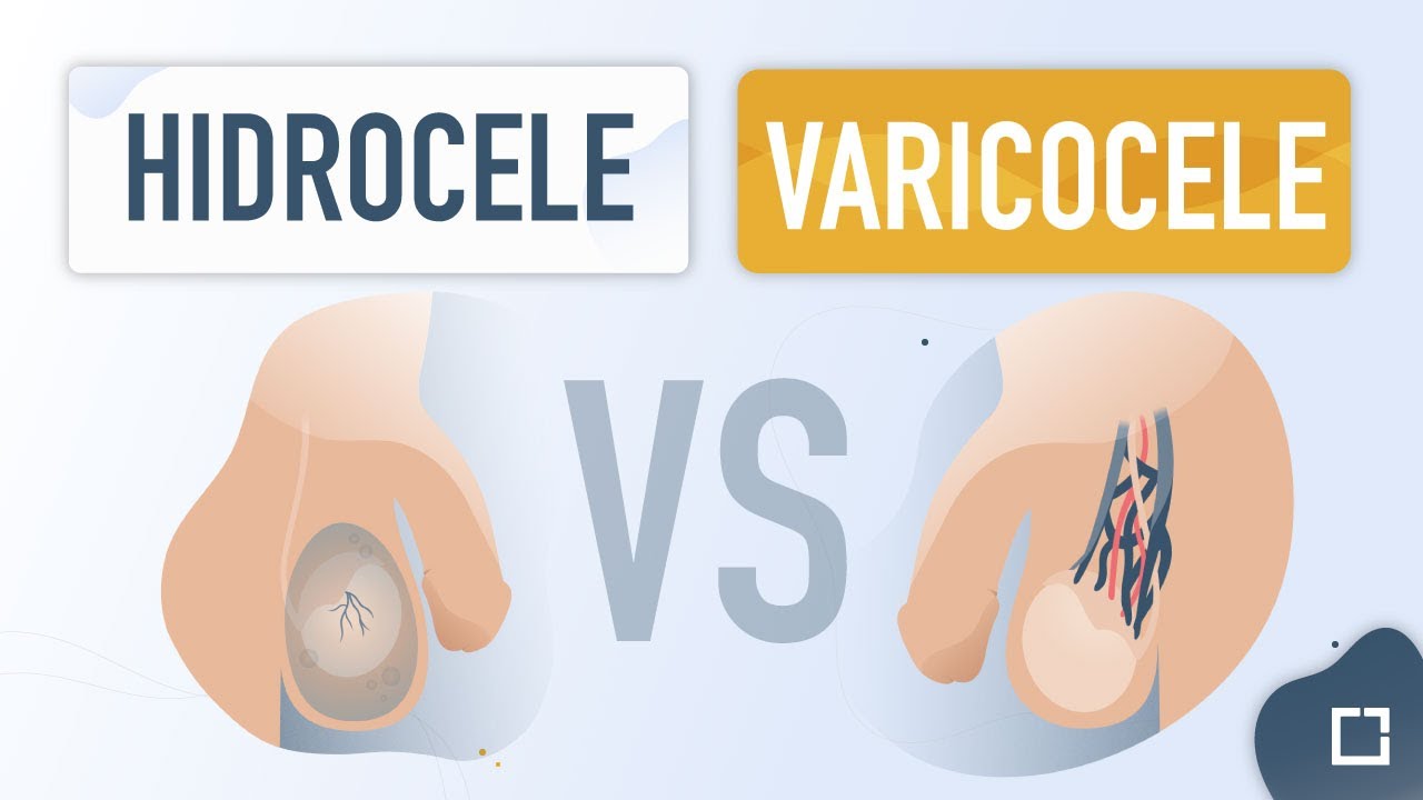 Diferencias entre HIDROCELE Y VARICOCELE.