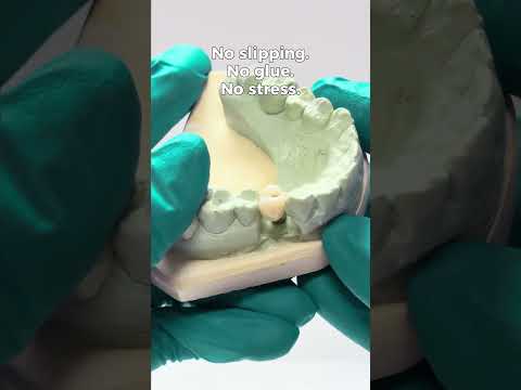 Missing teeth? We've got you. 🦷 #dentures #dentalimplant #onsitelab #bossiercity #implantdenture