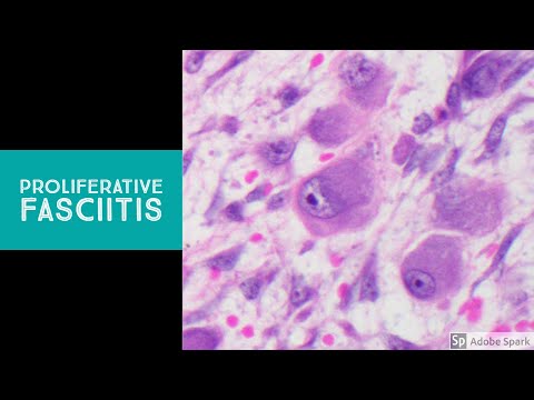 Proliferative Fasciitis & Myositis...Explained by a Soft Tissue Pathologist