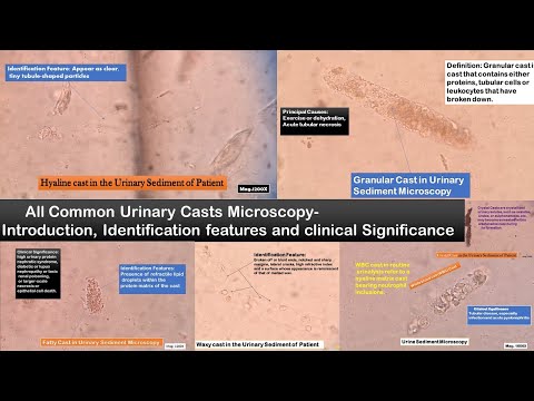 All common urinary casts: Introduction, Identification tips and clinical significance