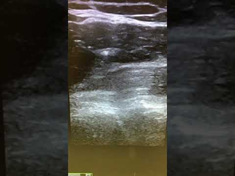 Suprascapular Nerve Block