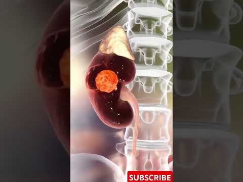 Kidney Cancer