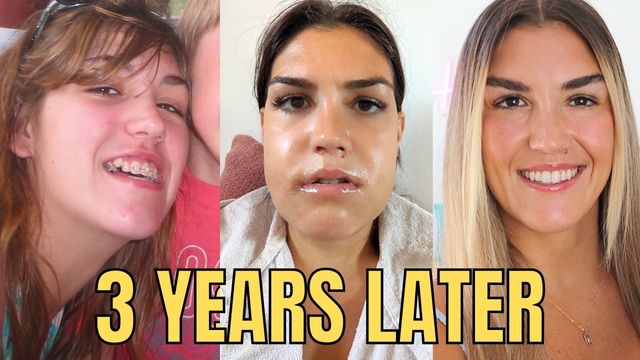 Do I Regret My Double Jaw Surgery? My Honest Experience with Recovery and My Results