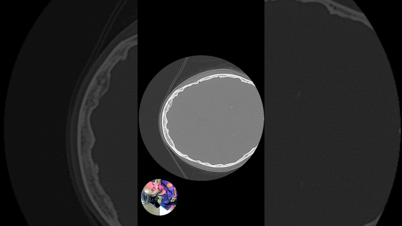 CT Reporting - Hyperostosis frontalis interna