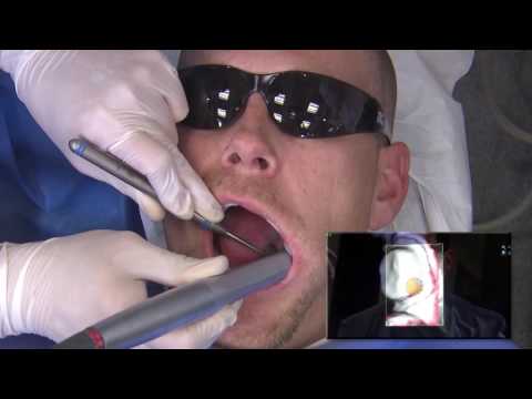 Case of the Week: Digital Obsidian® Crowns in One Day