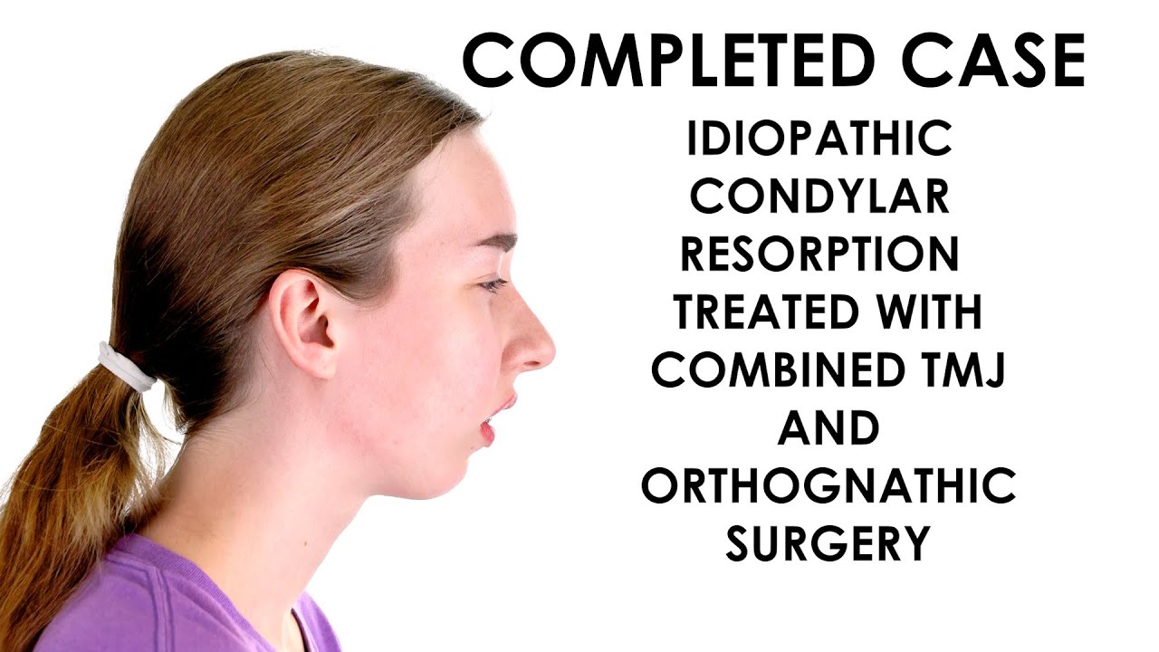 Before & After Morph: Completed Case - Profile