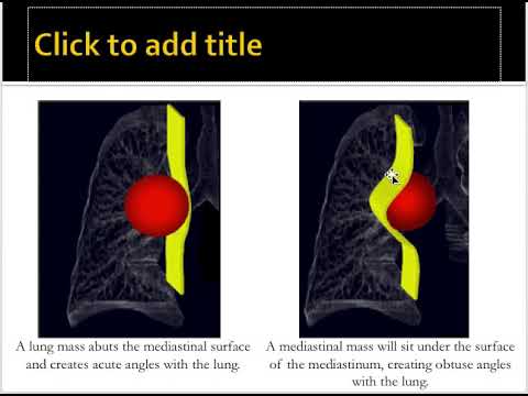 Mediastinal masses approach