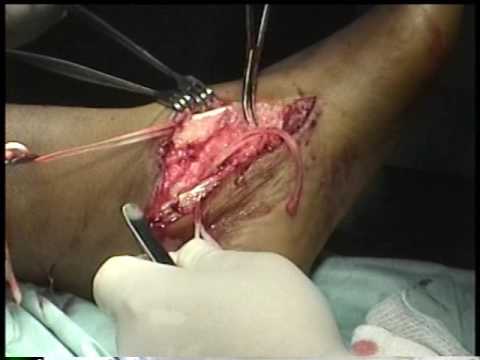 Percutaneus TAL Kidner Cobb flatfoot repair