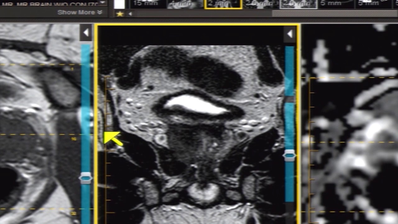 Introduction to Prostate Anatomy on MRI
