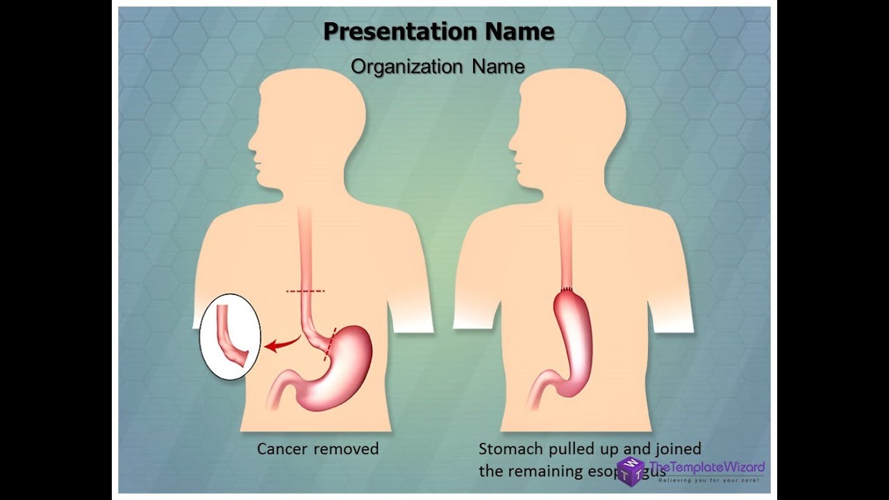 Esophageal Cancer Surgery PowerPoint Template - TheTemplateWizard.com