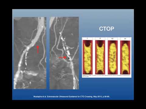 Total Iliac CTO Case