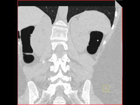 CASE3B.avi