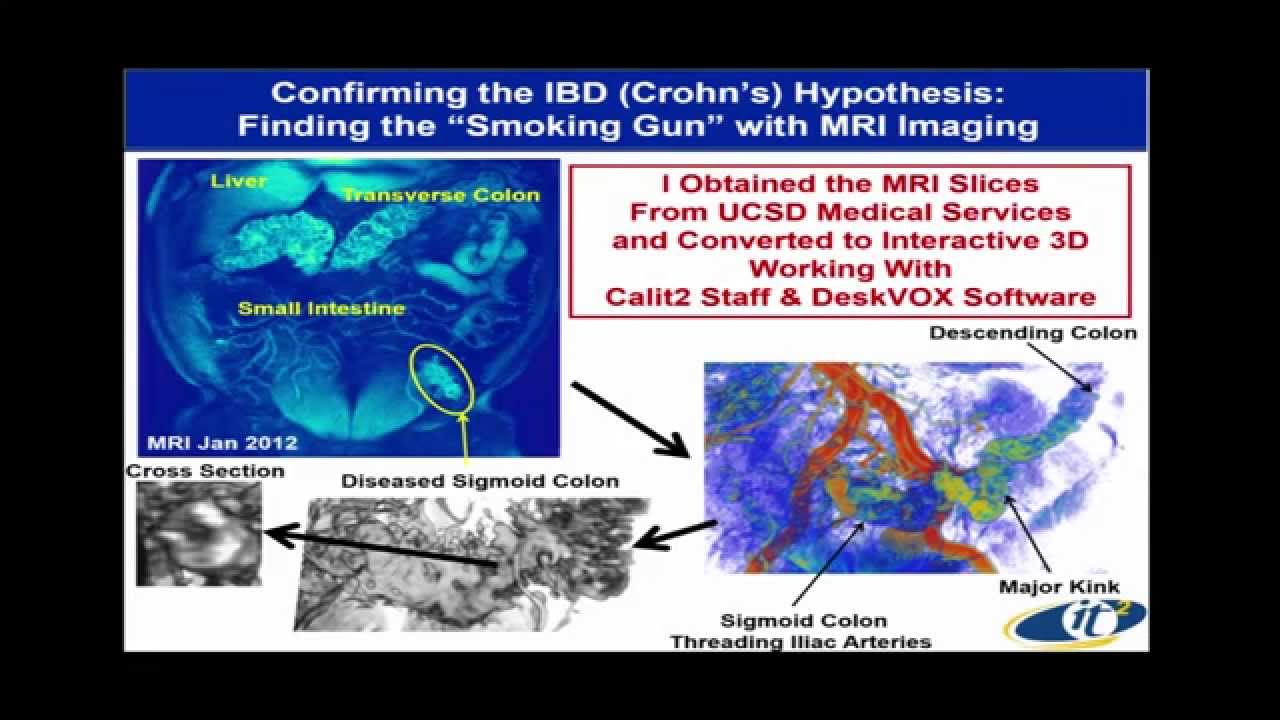 Larry Smarr - Quantifying The Dynamics of Your Superorganism Body Using Big Data Supercomputing