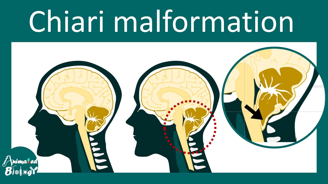 Chiari Malformation and Treatment | Type I and II Chiari malformation