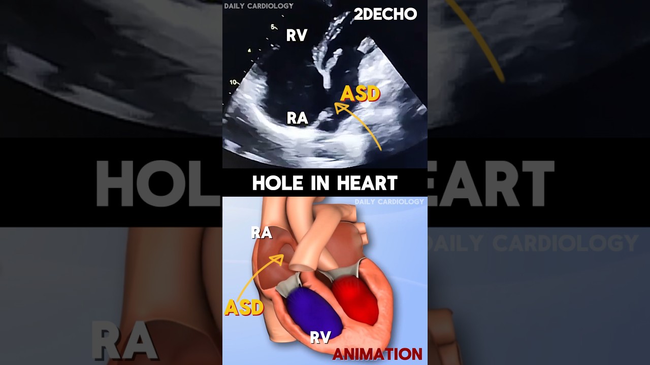 Atrial Septal Defect (ASD) Hole in Heart (2DEcho vs Animation) #shorts #asd #echocardiography