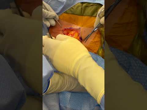 Excision of Hip Lipoma