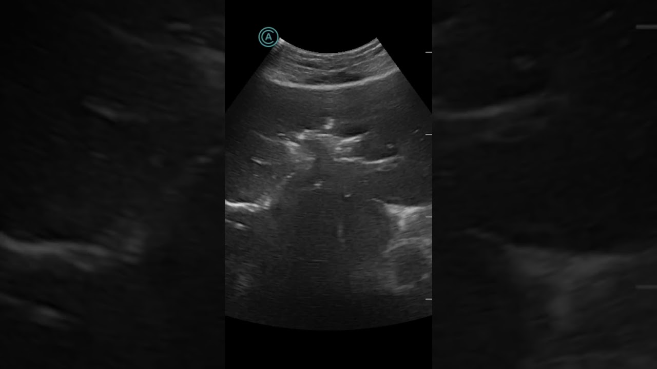 Pneumobilia (post ERCP with stent) #Apache