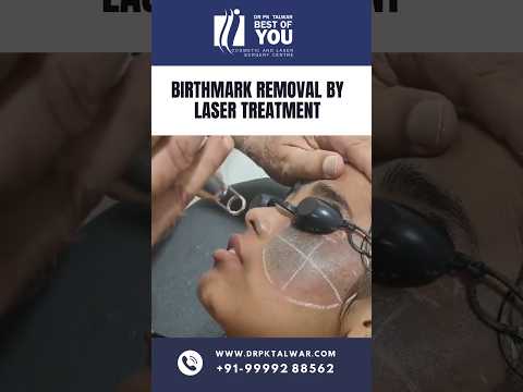 Birthmark Removal by Laser Treatment | Birthmark Removal Treatment in Delhi | Dr. PK Talwar