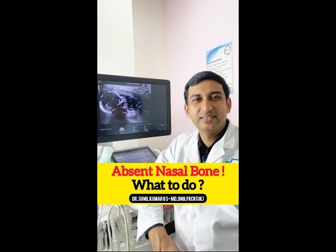 Absent Nasal Bone| Dr. Sunil Kumar G S| #absentnasalbone #pregnancycare #pregnancyjourney #baby