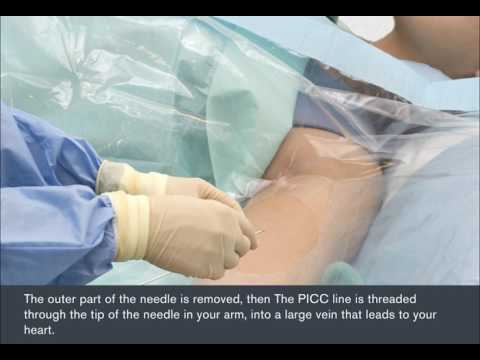 Having a Peripherally Inserted Central Catheter (PICC)