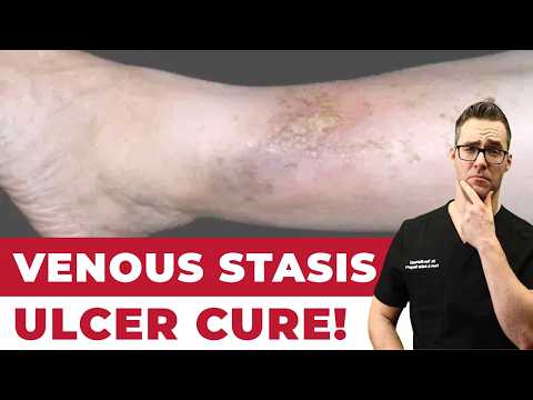 Venous Stasis Dermatitis & Venous Ulcers Treatment! [Varicose Veins ...