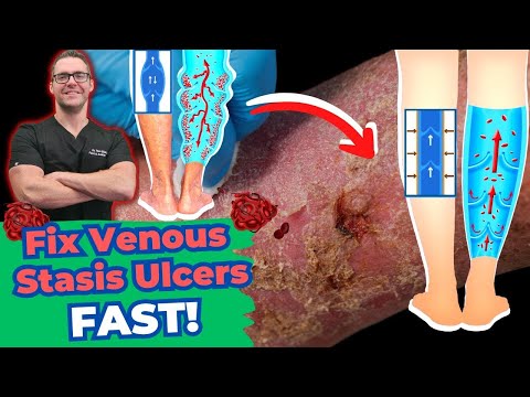Venous Stasis Dermatitis & Venous Ulcers Treatment! [Varicose Veins]