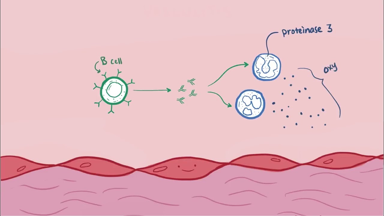 Vasculitis | Osmosis