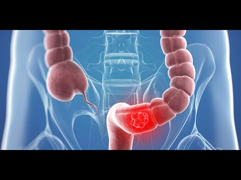 Partial Proctectomy CPT code - simplify medical coding