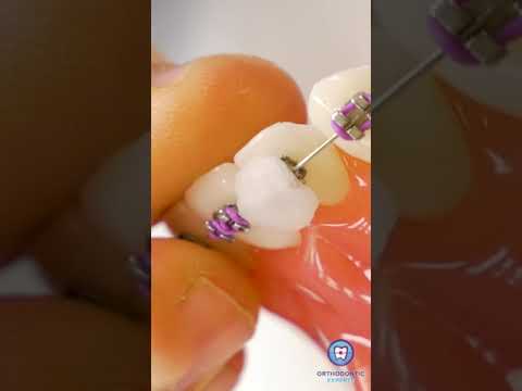 Braces Emergencies | Poking Ligature | #Shorts