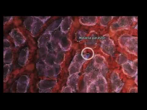 What malaria looks like – Rambles Blog at Star Chamber