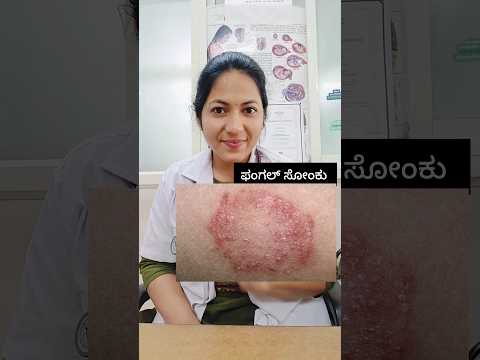 Don't do this mistake #kannada #drdivya #fungal #fungalinfection #skincare #skininfection #healtht
