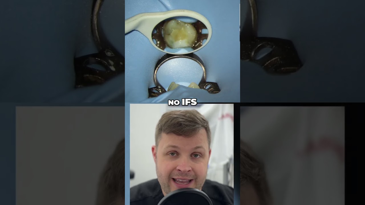Rubber Dam  Root Canal MUST HAVE!