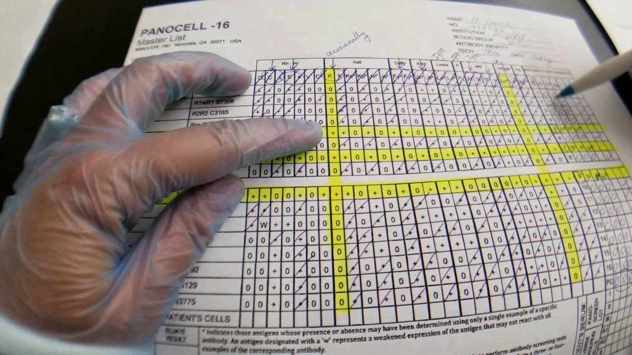 Blood Banking: Antibody Identification Panel Interpretation Part 2