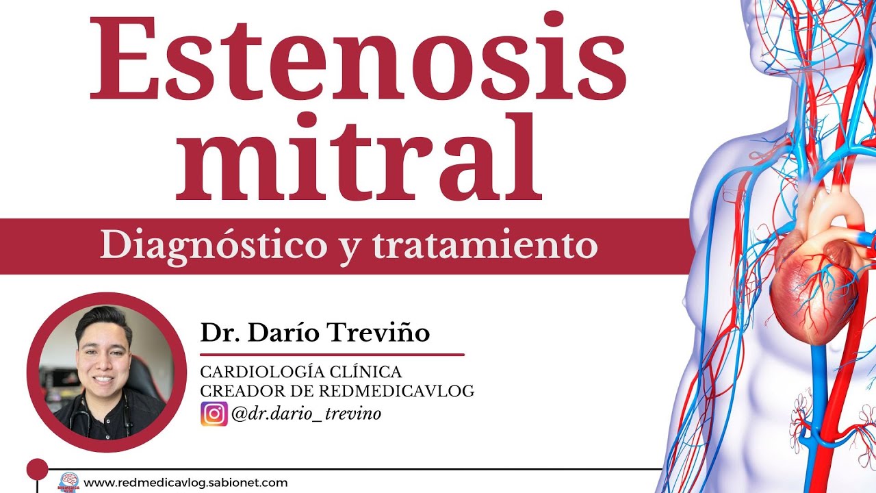 Estenosis mitral (diagnóstico y tratamiento) #Cardiología | 🩺 Dr. Treviño