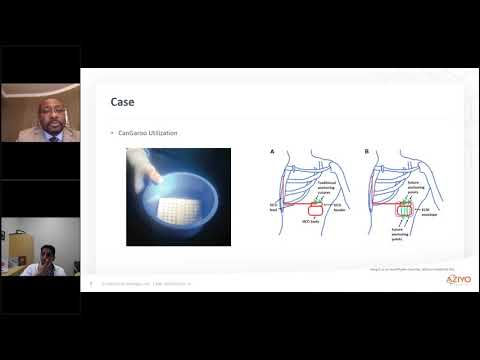 Live Case Study Discussions: Mitigating Complications Associated with CIED Implantation