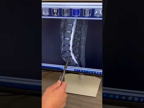 Dr. Rovner Explains MRI Before & After Surgery