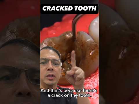 How to EASILY Extract a Cracked Tooth (First Molar) | In Office to Hands On Dental Training #shorts