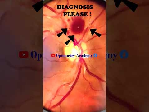 BRVO | Macular Oedema | Diagnosis Please | Short Video 316 #viral #optometryacademy #optometry #eyes