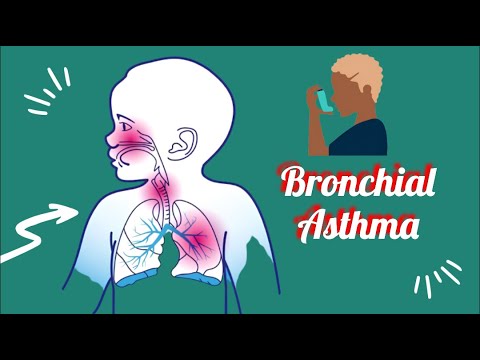 What is bronchial asthma? Clinical picture and management