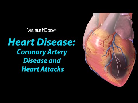 Visible Body | Heart Disease: CAD and Heart Attacks