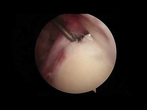 Arthroscopic view of the shoulder after manipulation under anesthesia