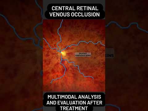 CENTRAL RETINAL VENOUS OCCLUSION #optometrist #ophthalmology #eyedisorder #retina #eyedisease #eyes