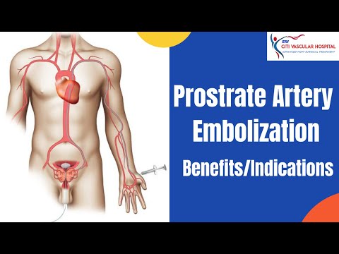 Prostate Artery Embolization (PAE) Indications, Benefits, Review, Advantages over the surgery