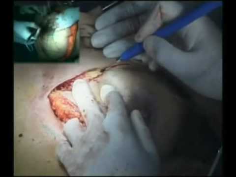 TM AC TRAM flap, Dr.Gopinath
