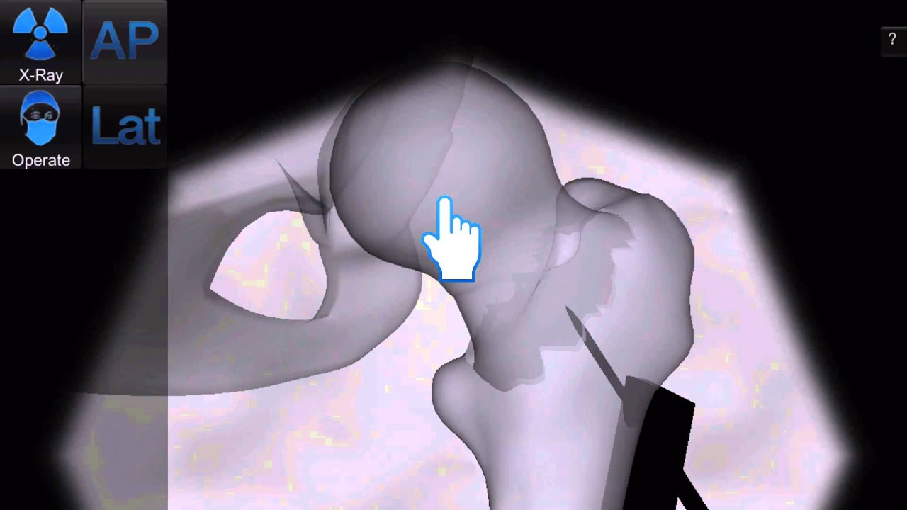 Bonedoc - Placing the guidewire