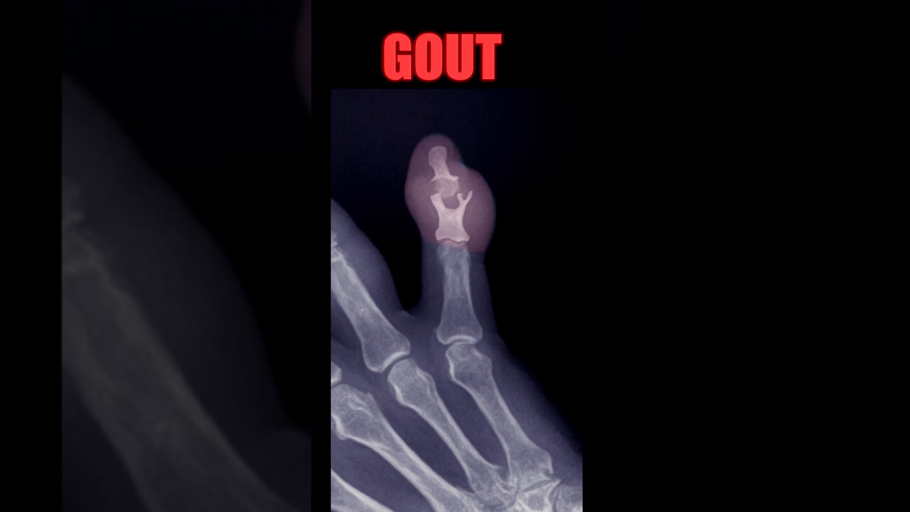 Gout on X-Ray